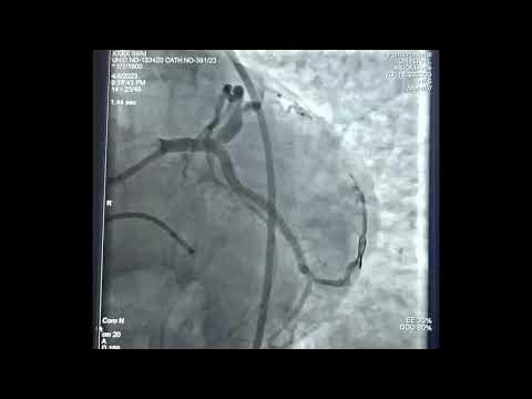 Left main LCX LAD bifurcation PTCA by TAP technique - YouTube