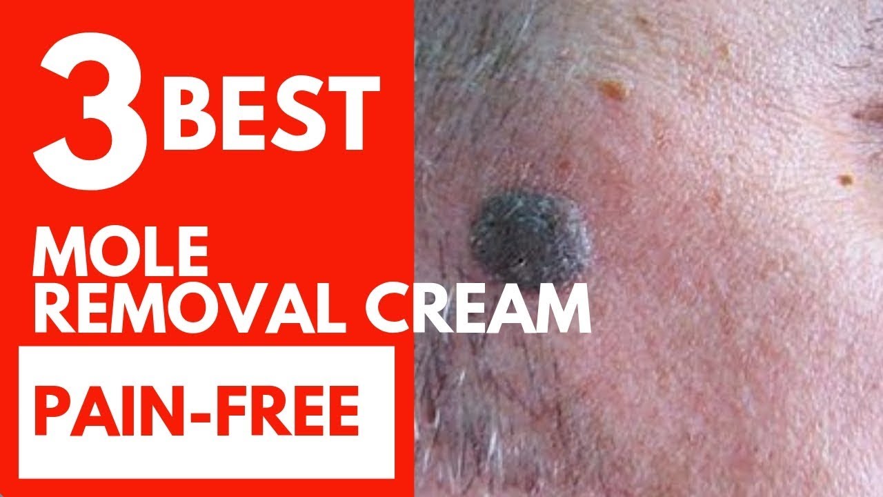 Top 3 Best mole removal cream-Surgical Alternative and pain-free - YouTube