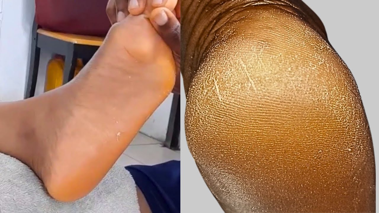 How to Remove Callus and Scales From Heels | Crusty Heel Removal ...
