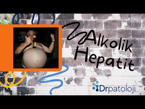 Alkolik Hepatit