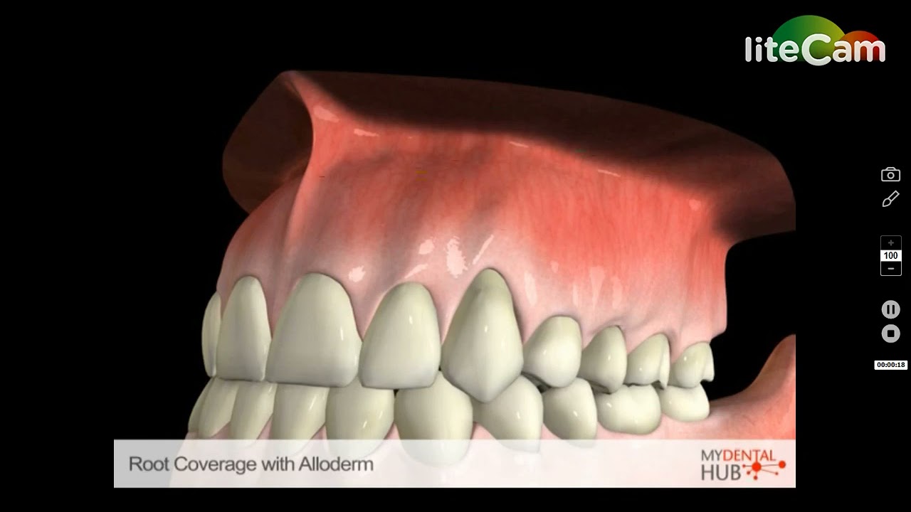 Gingival Grafting - Cadaver Tissue - YouTube