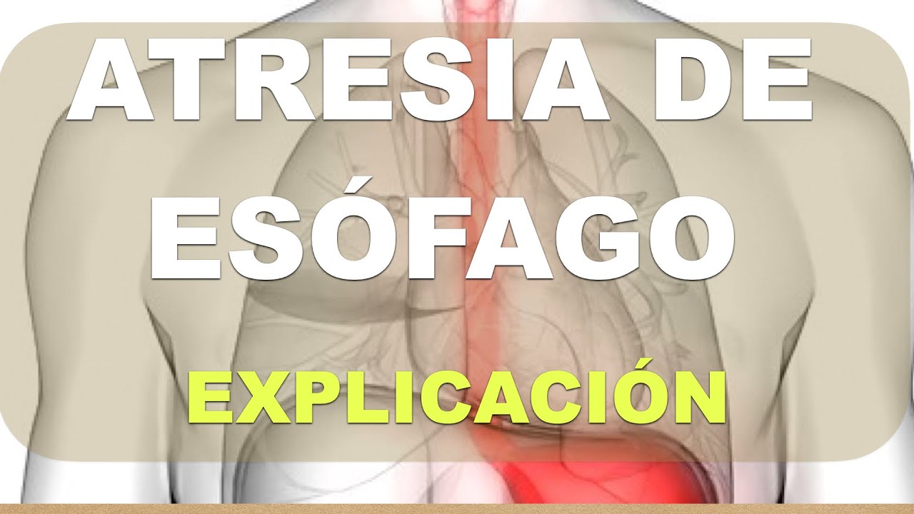 Qué es la ATRESIA ESOFÁGICA. Explicación sencilla - YouTube
