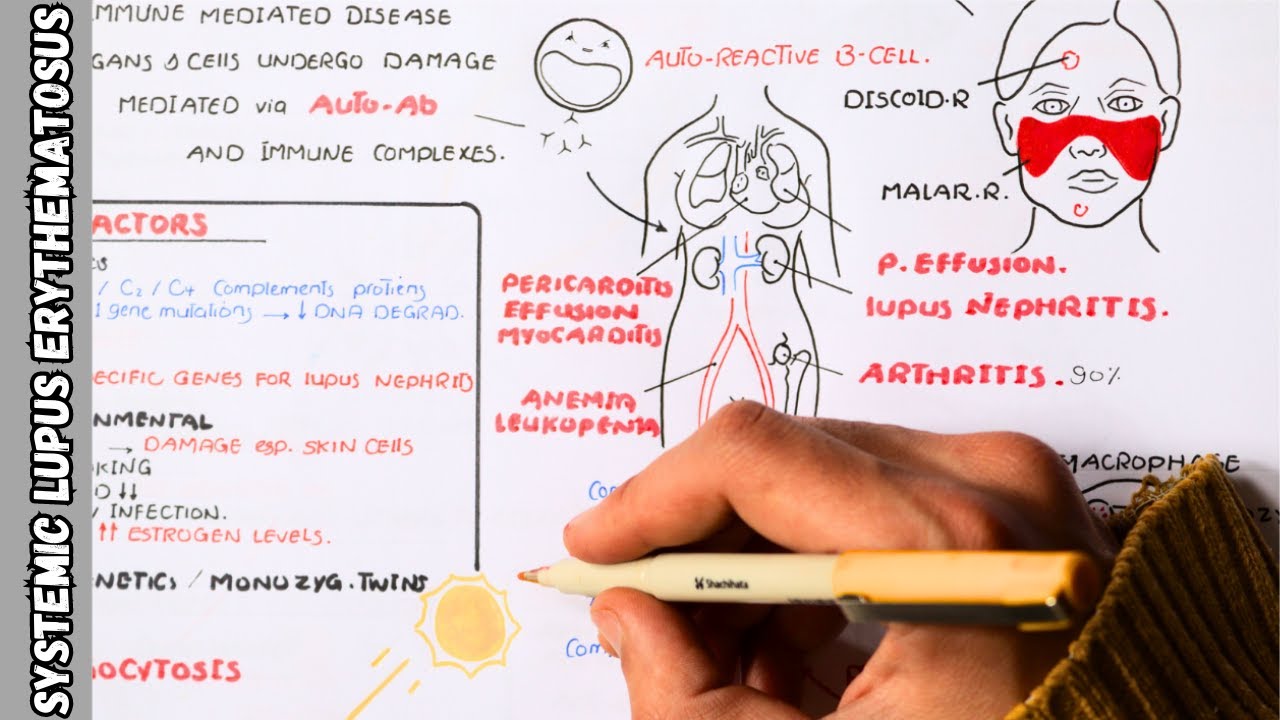 Systemic Lupus Erythematosus (SLE) _ signs and symptoms ...