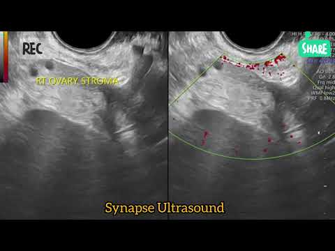 Ovarian torsion with Cyst