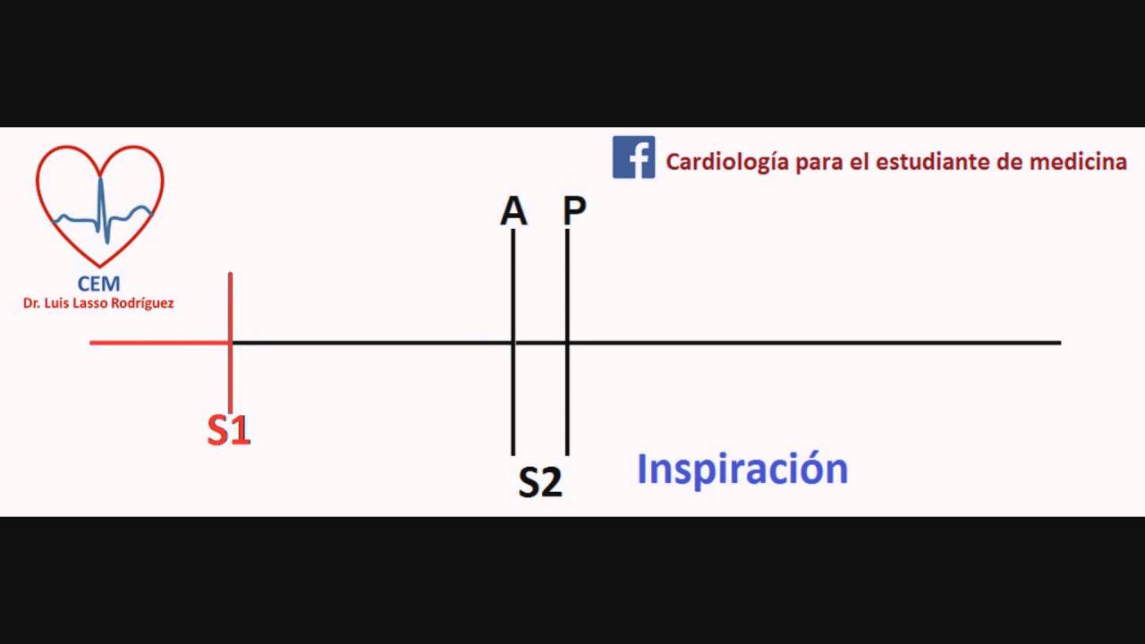 Auscultación del desdoblamiento fisiologico del 2do ruido - YouTube