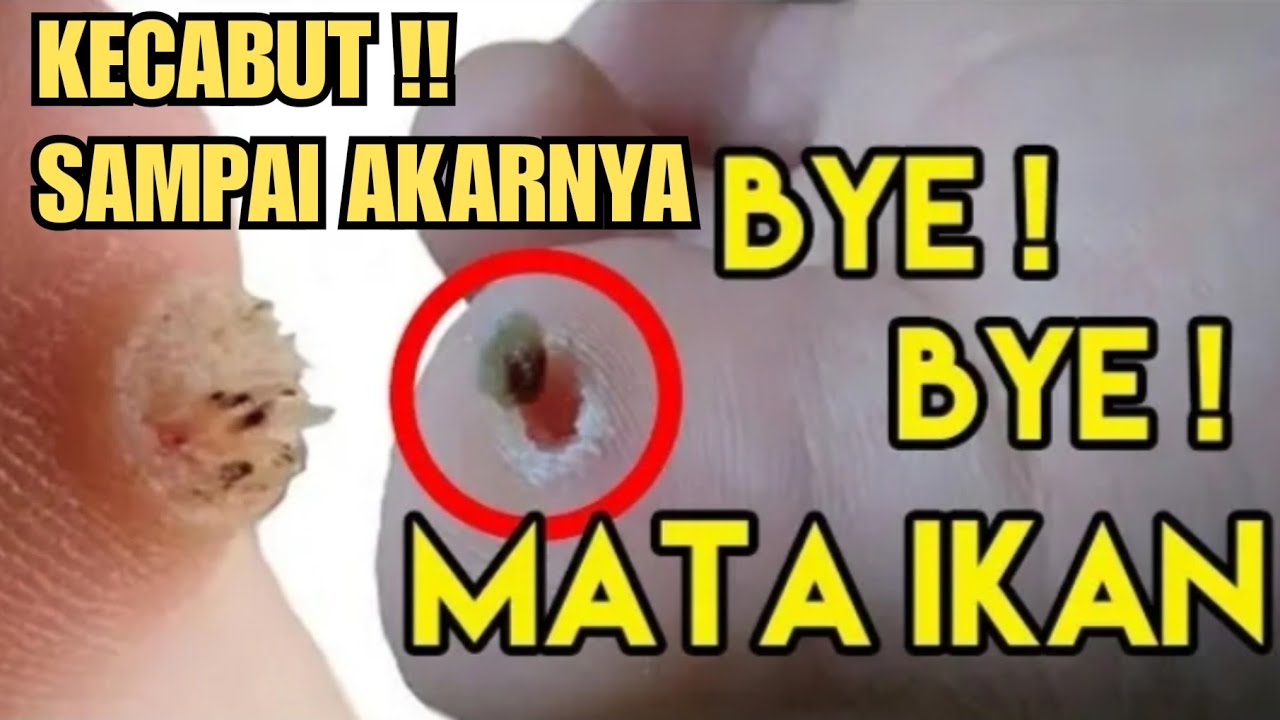 1 MENIT !! MATA IKAN HILANG SAMPAI KE AKARNYA CUMA PAKE INI... - YouTube