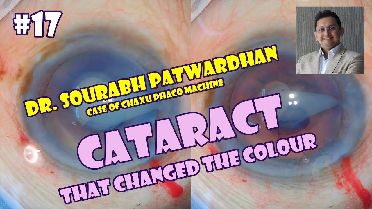 17 Morgagnian cataract Dr Sourabh Patwardhan using Chaxu phaco machine ...