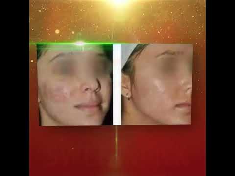 MAGIC SCAR REMOVER GEL [AUTHENTIC] BUY 1 GET 1 - YouTube
