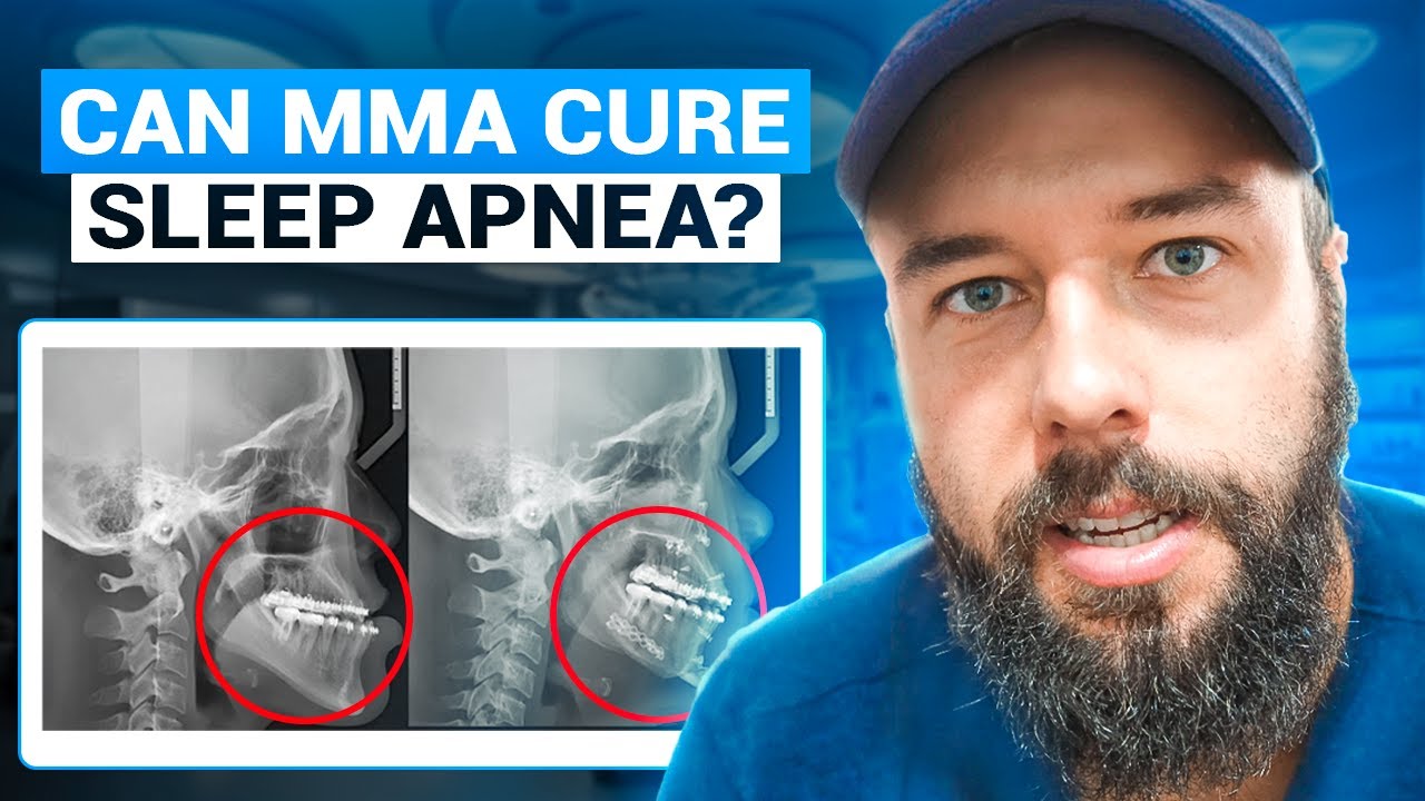 jaw surgery for Sleep Apnea? Here are some things to know. - YouTube