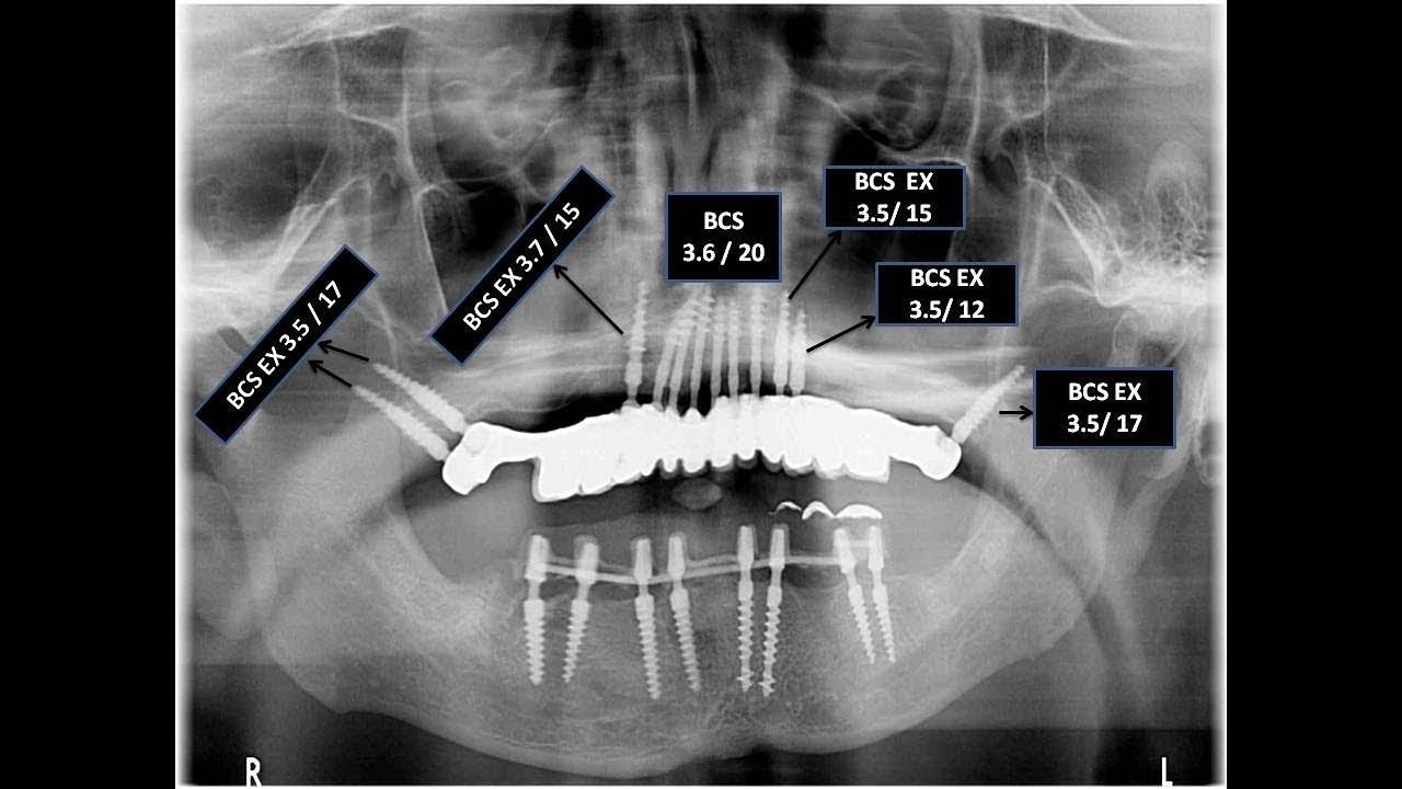 Atrophic maxilla reconstruction with strategic basal implants without ...