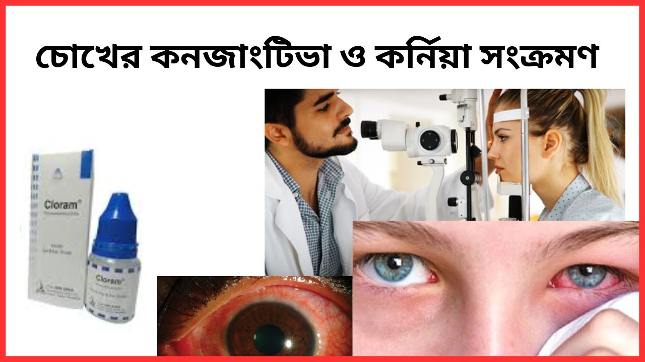 Cloram Eye drop Chloramphenicol চোখ উঠা চোখ লাল হয়ে যাওয়া চোখে পোকা ...