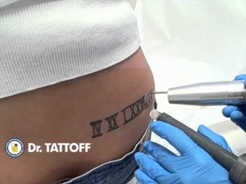 Tattoo Removal - Lower Back Laser Tattoo Removal -  Dr TATTOFF  -  888-828-8633