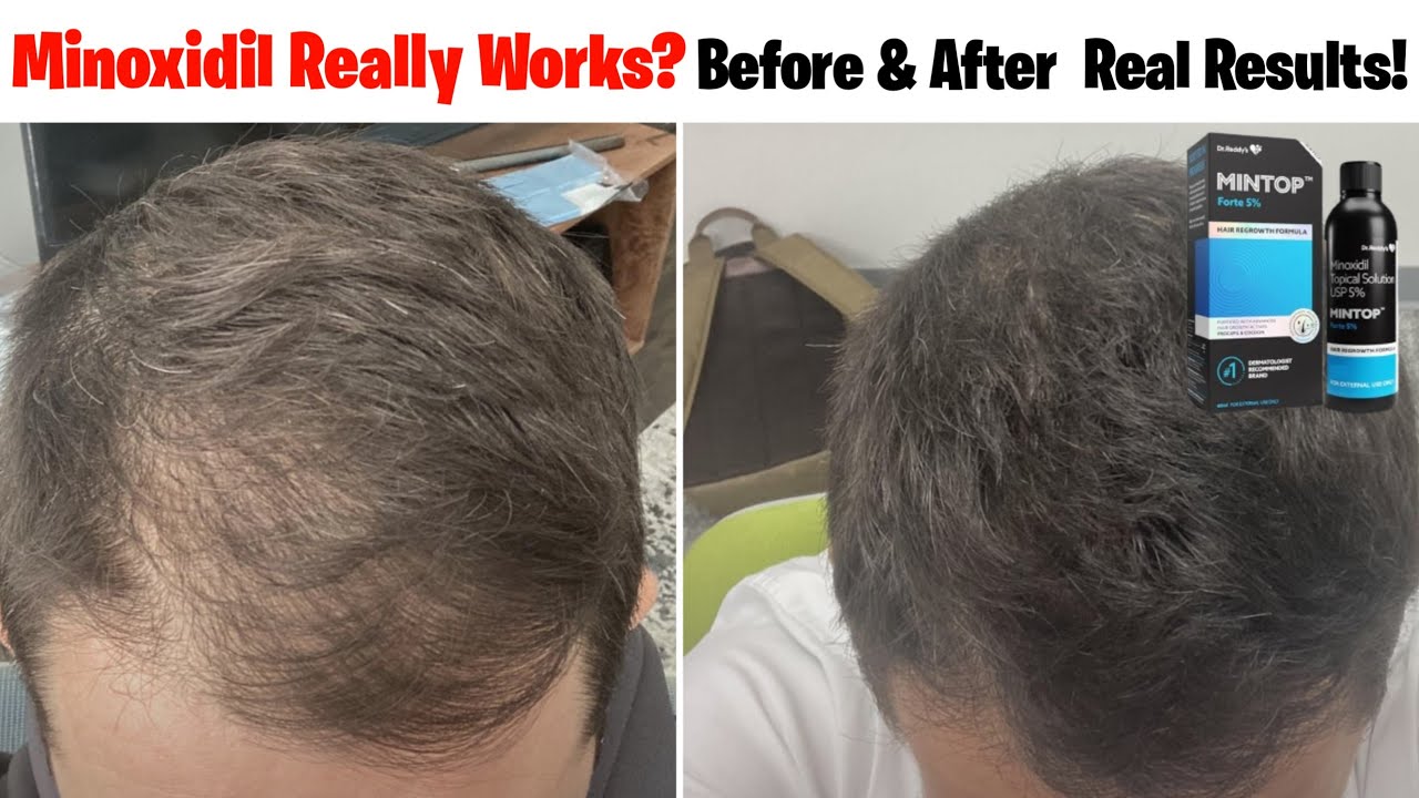 Minoxidil Hair Regrowth Journey | Does It Really Work? Minoxidil Review ...