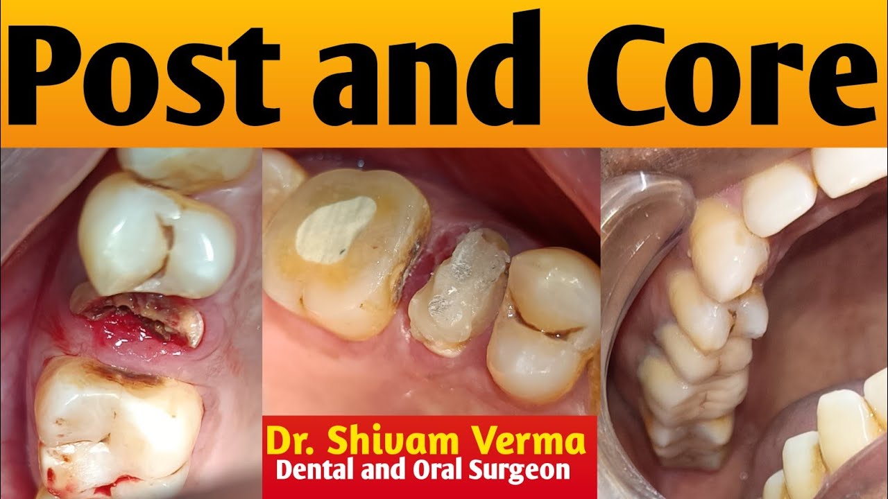 Broken Tooth Repair Fiber Post and Core filling and Capping By Dr ...