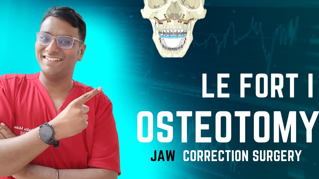 Dr Rudra Mohan |Transforming Smiles:The Amazing Le Fort 1 Osteotomy ...
