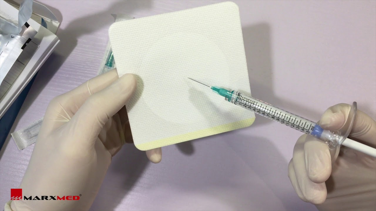 Radiesse Syringe Overview - YouTube