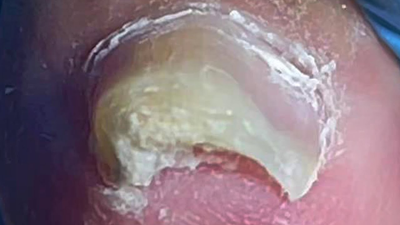 Curly ingrown nails, very thick germs infecting one layer of the nail ...