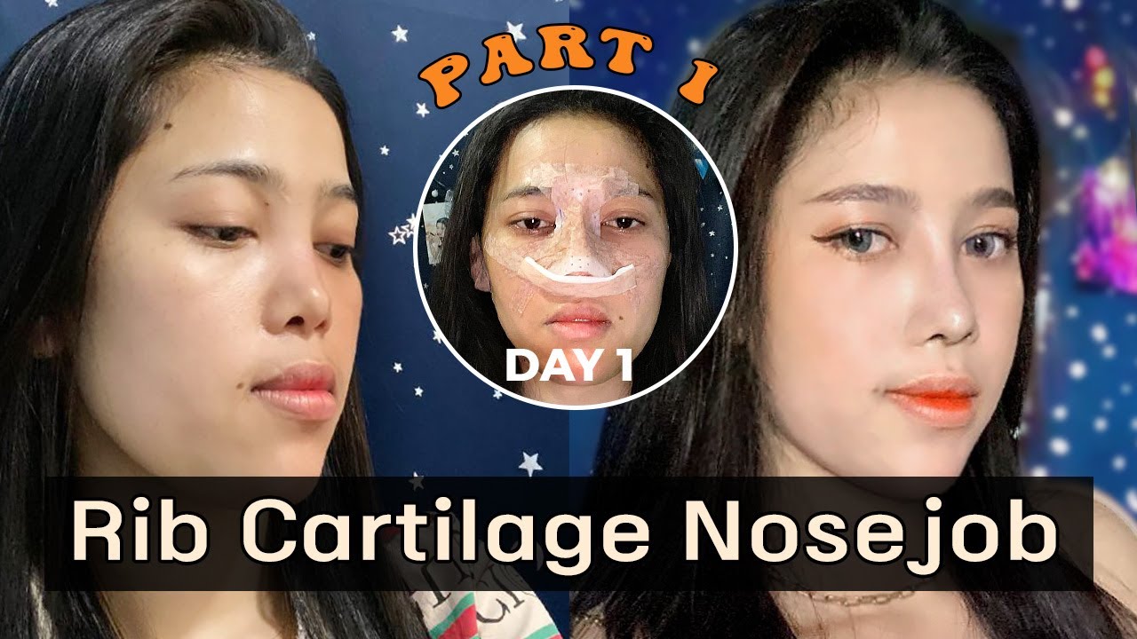 [SUB] Rhinoplasty with Rib Cartilage | Influencer's Nosejob Vlog in ...