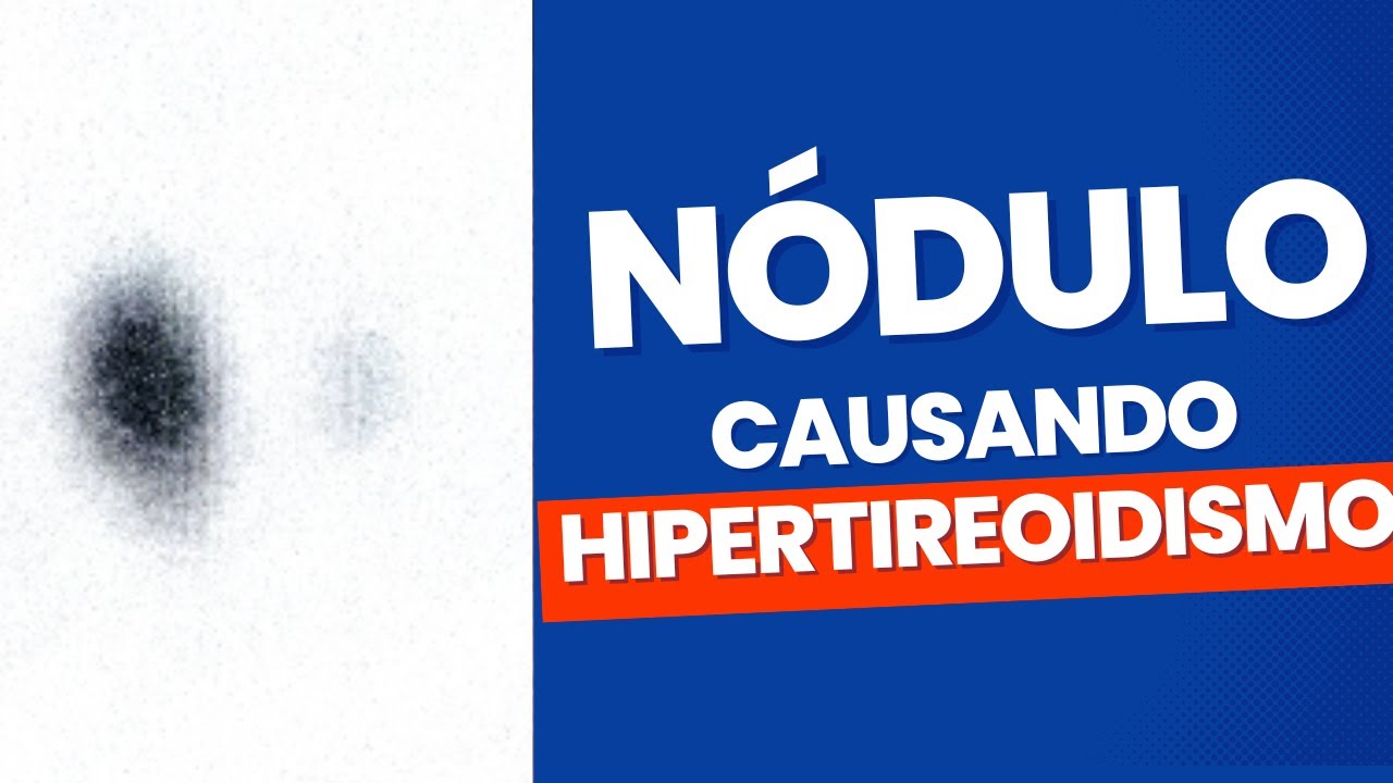 Doença de Plummer: Nódulo causando hipertireoidismo - YouTube