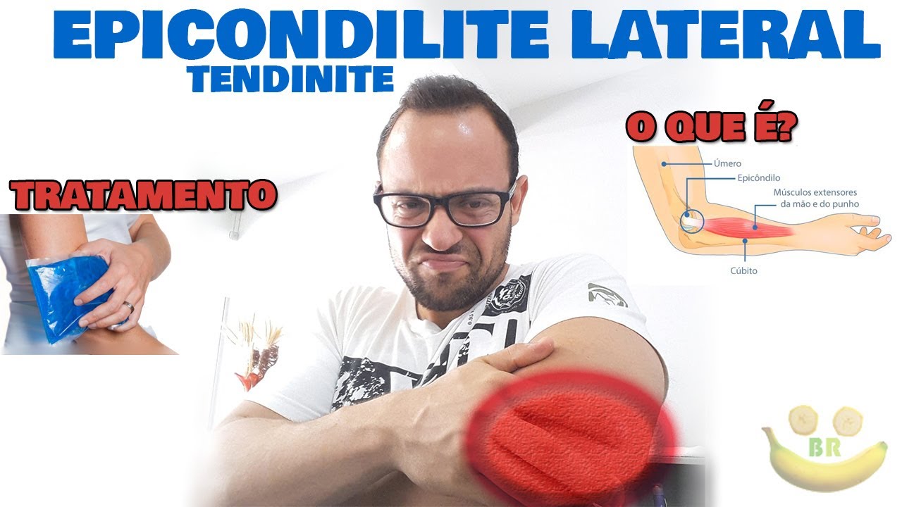 O que é Epicondilite Lateral? *tratamento para tendinite* - YouTube