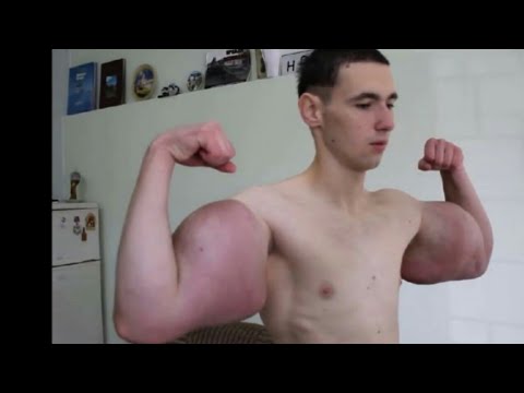 SYNTHOL KID GETS HIS ARMS DRAINED - REACTION - YouTube
