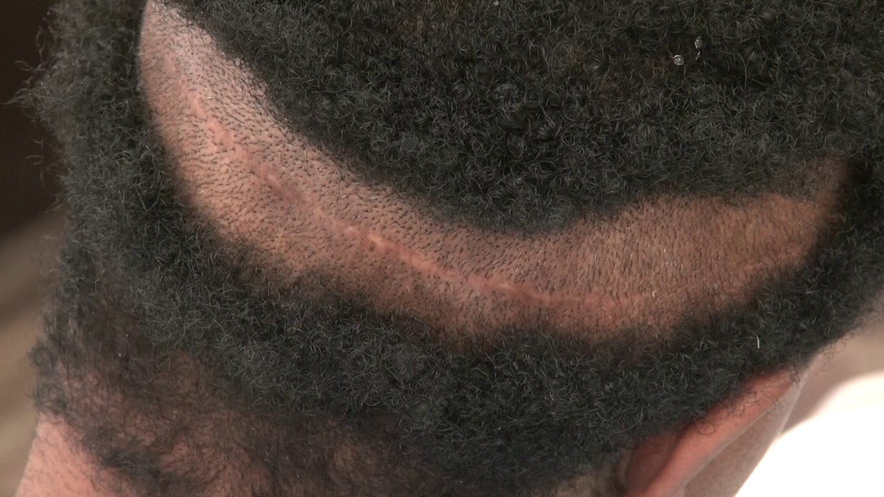 FUT Hair Transplant Scar on Black African Dr. Diep Back of the Head ...