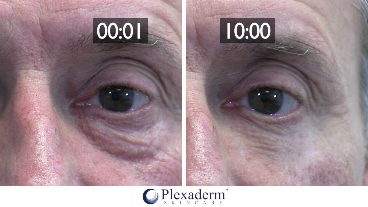 How to Erase Bags Under Your Eyes With Plexaderm™ - YouTube