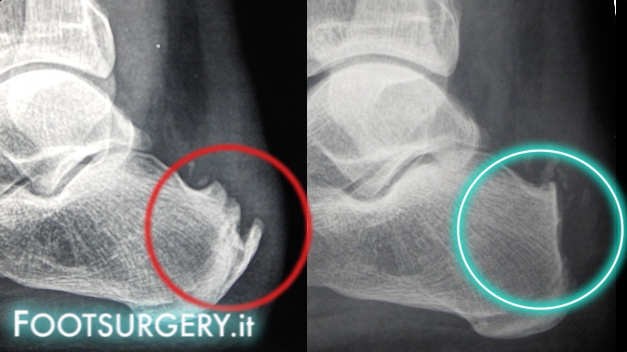 Malattia di Haglund, un mese dopo l'intervento - YouTube