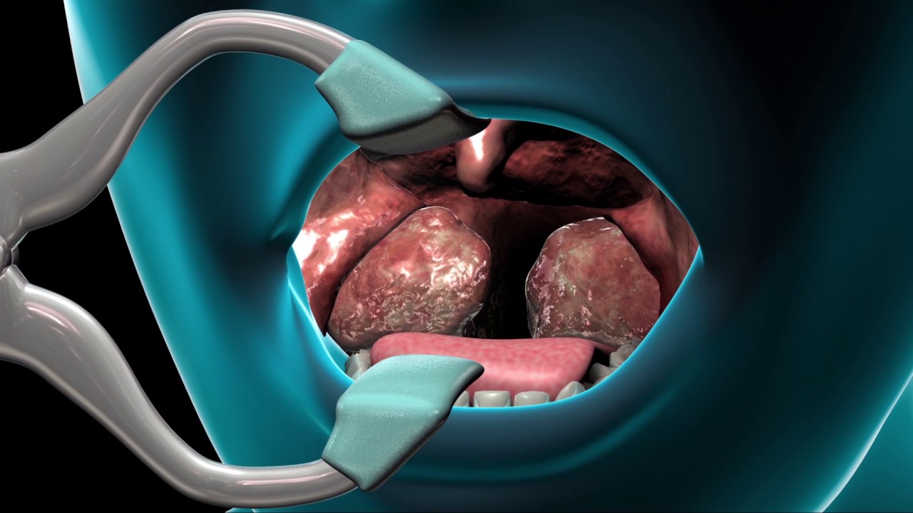 Learn about removal of tonsils - YouTube