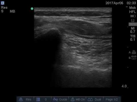 Ultrasound guided sacroiliac joint injection. - YouTube