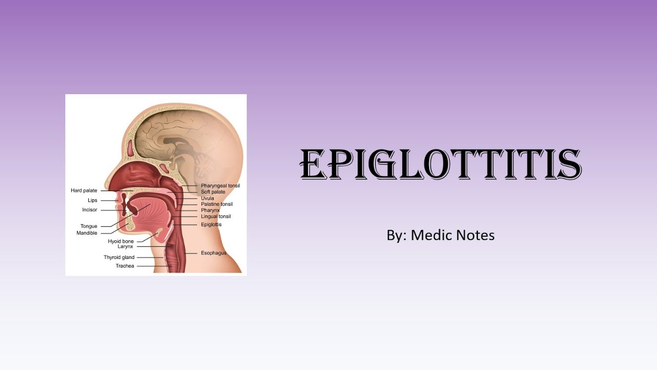 Epiglottitis - causes, signs and symptoms, investigation, management ...