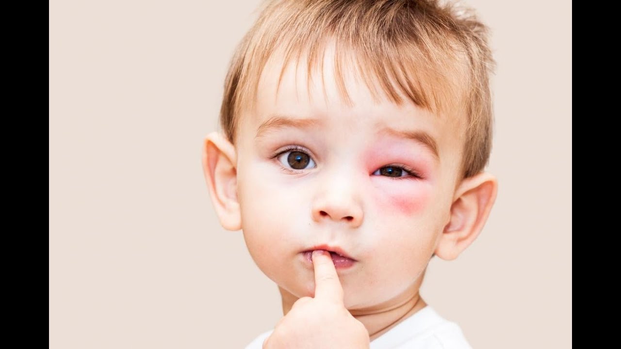 Treating insect bites in the eye ... Here are the ideal ways to avoid ...
