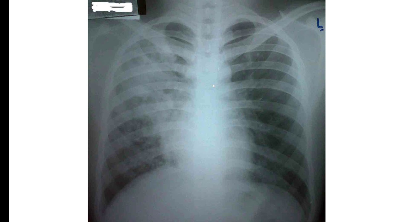 Skill lab 3 : rontgen tb paru Jofani dimas perdana 19310064 kel 6 - YouTube