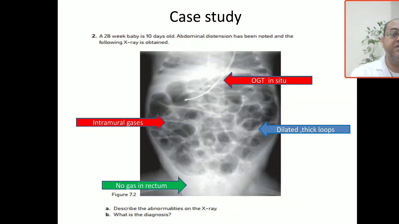 Pneumatosis Intestinalis Necrotizing Enterocolitis