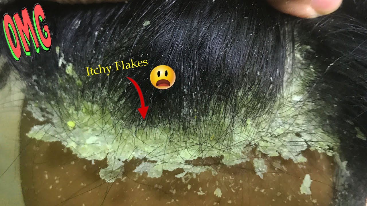 The Best Of The Itchy Scalp!! Daily Dandruff Big Flakes Scratching #126 ...