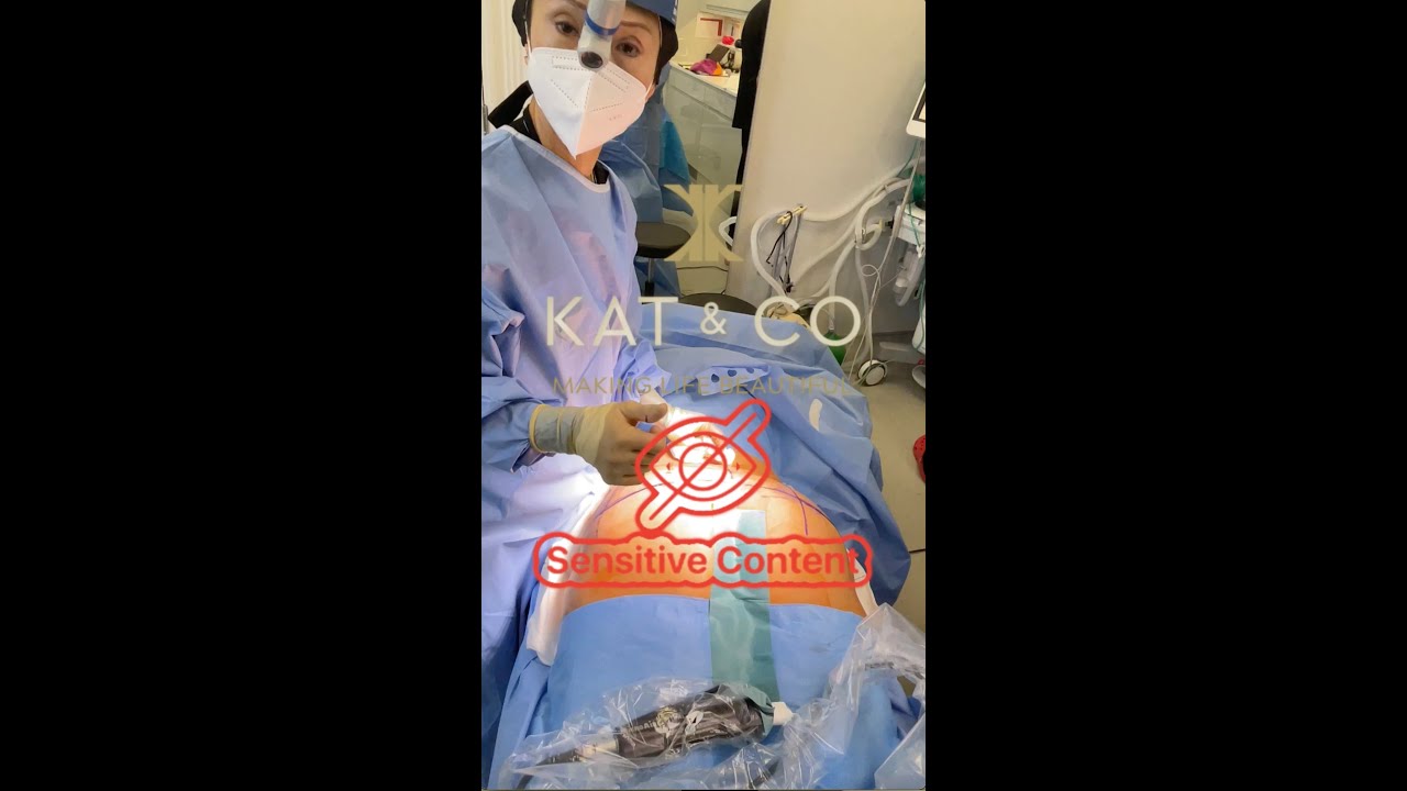 360˚ Body Lift : Part 1 - the back reduction - YouTube