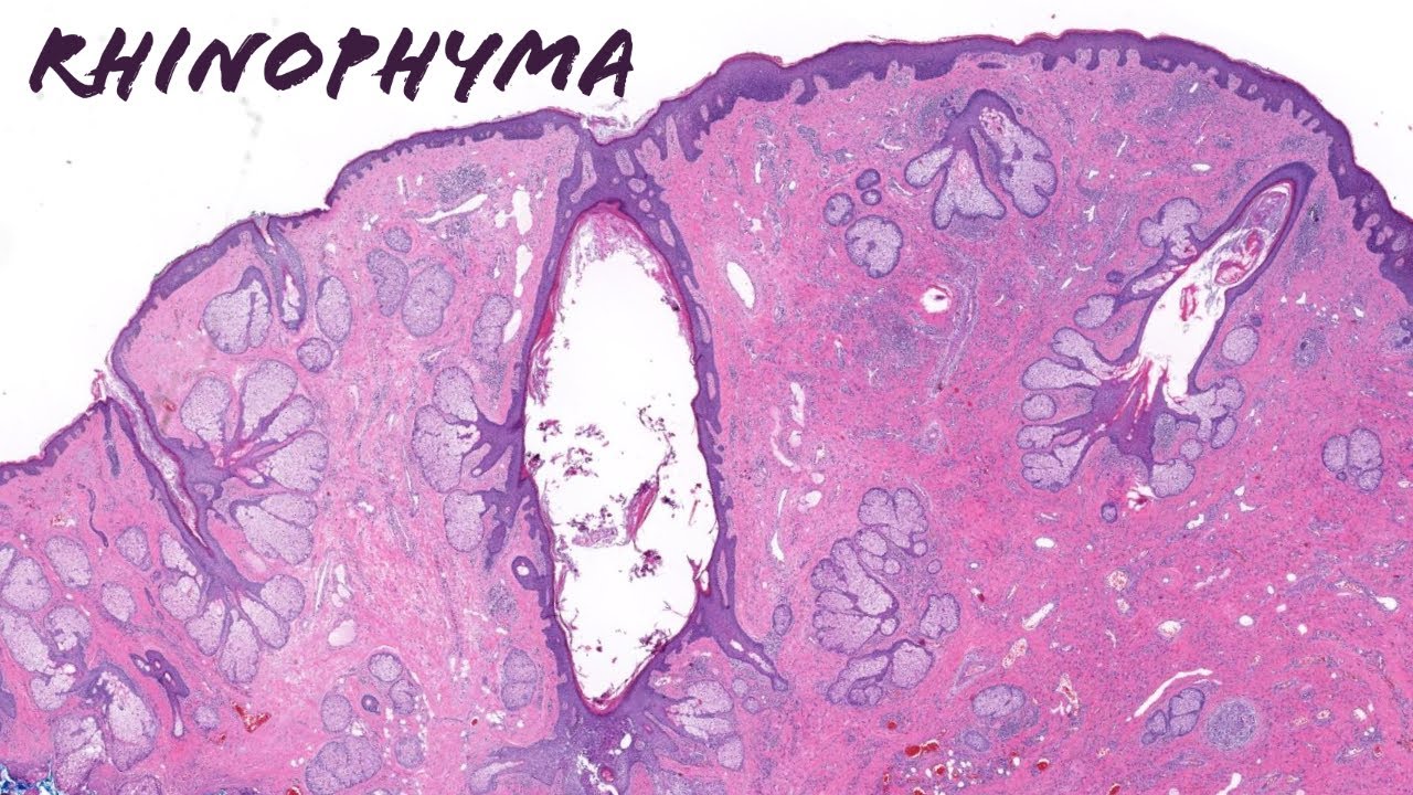 Rhinophyma Histology