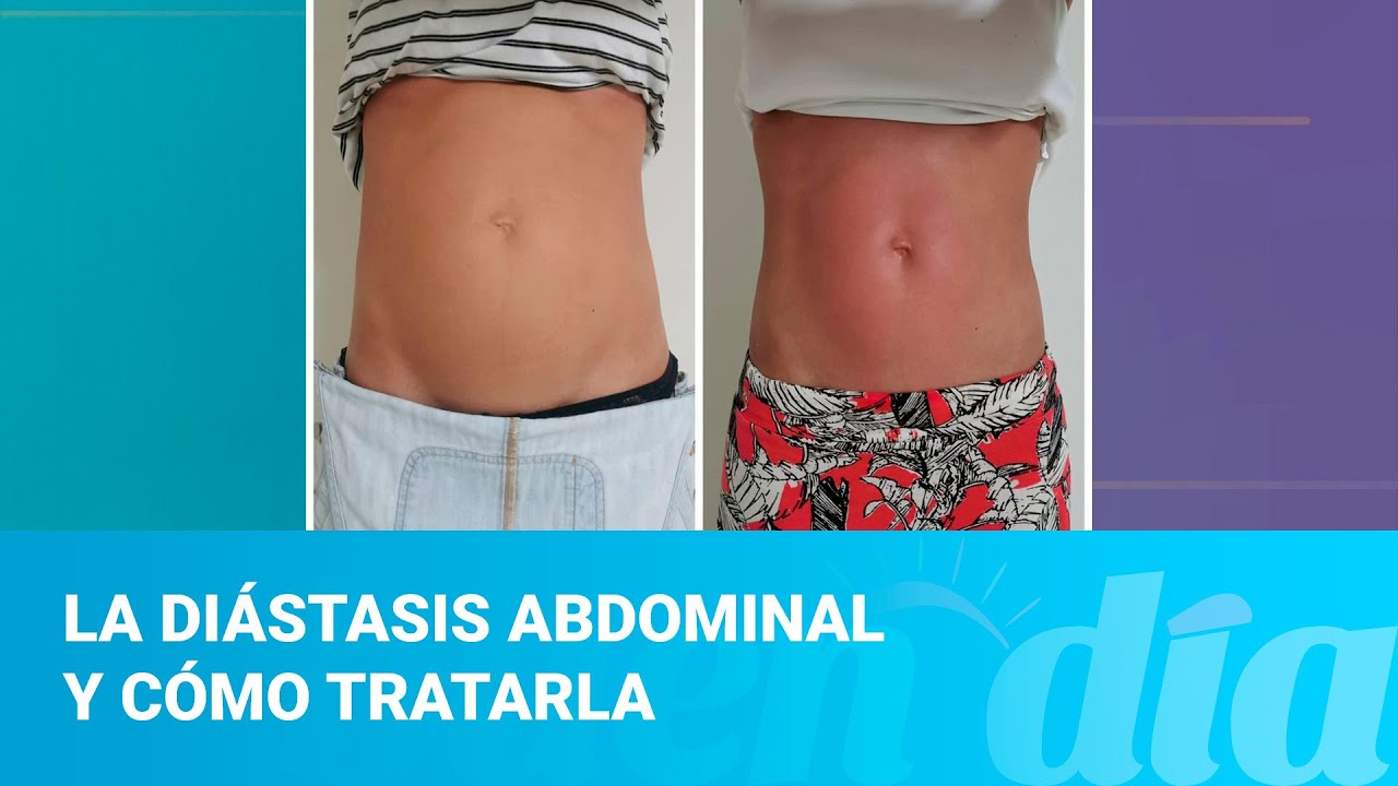 La diástasis abdominal y cómo tratarla - YouTube