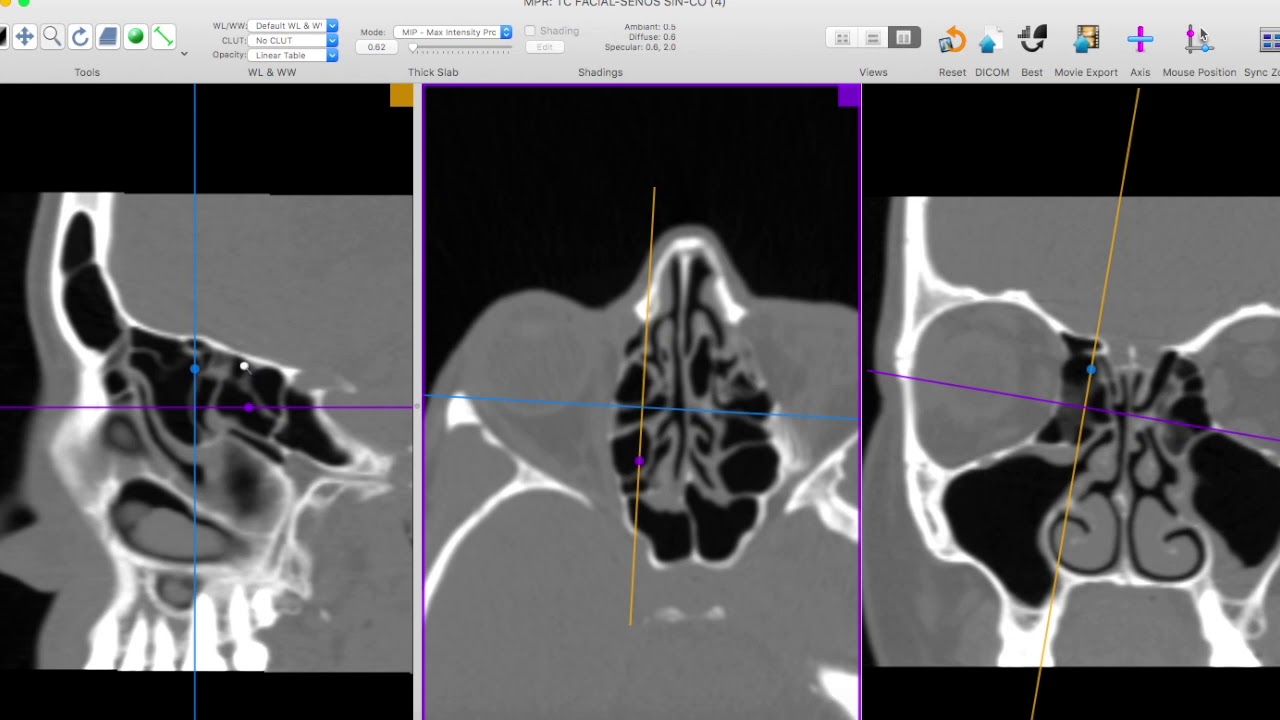 Cómo estudiar el seno etmoidal video - YouTube