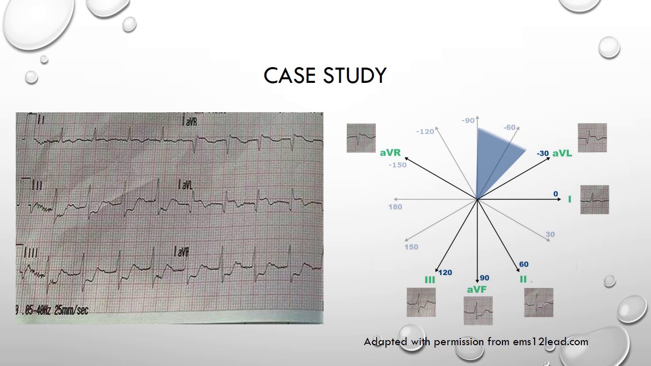 12 Lead ECG Episode 11 Case Study STEMI Equivalent aVL - YouTube