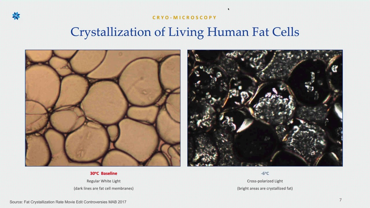 Fat cell journey death with CoolSculpting at Bodify - YouTube