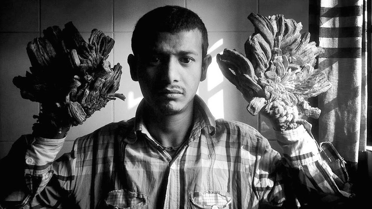 25 EXTREMELY Bizarre Medical DISORDERS - YouTube