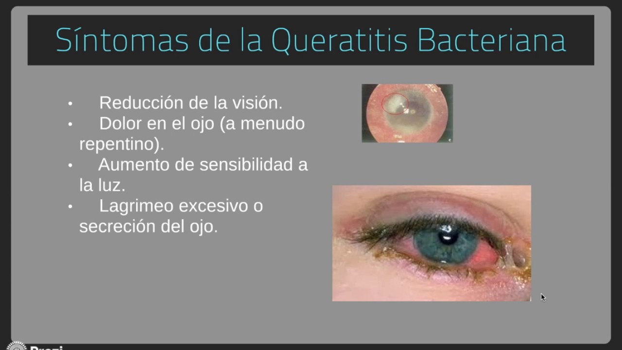 Queratitis infecciosa bacteriana por Astrid Larreta - YouTube