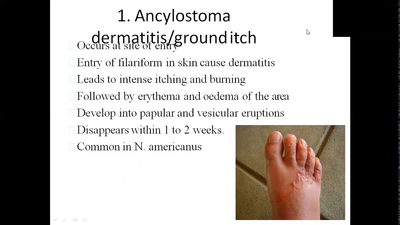 PATHOLOGY- HOOKWORM PART 2-B.H.M.S II - YouTube