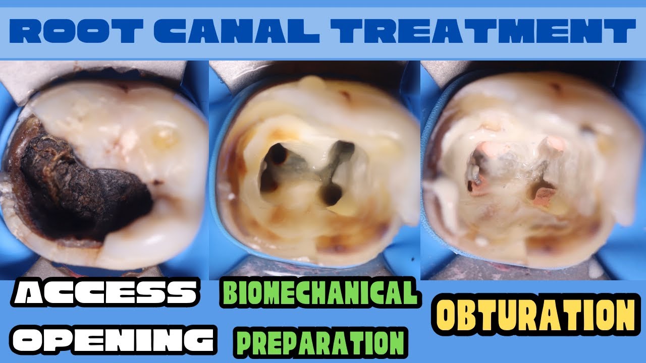 Root Canal Treatment 🔵 Mandibular Molar 🟡Access Opening🟢Biomechanical ...