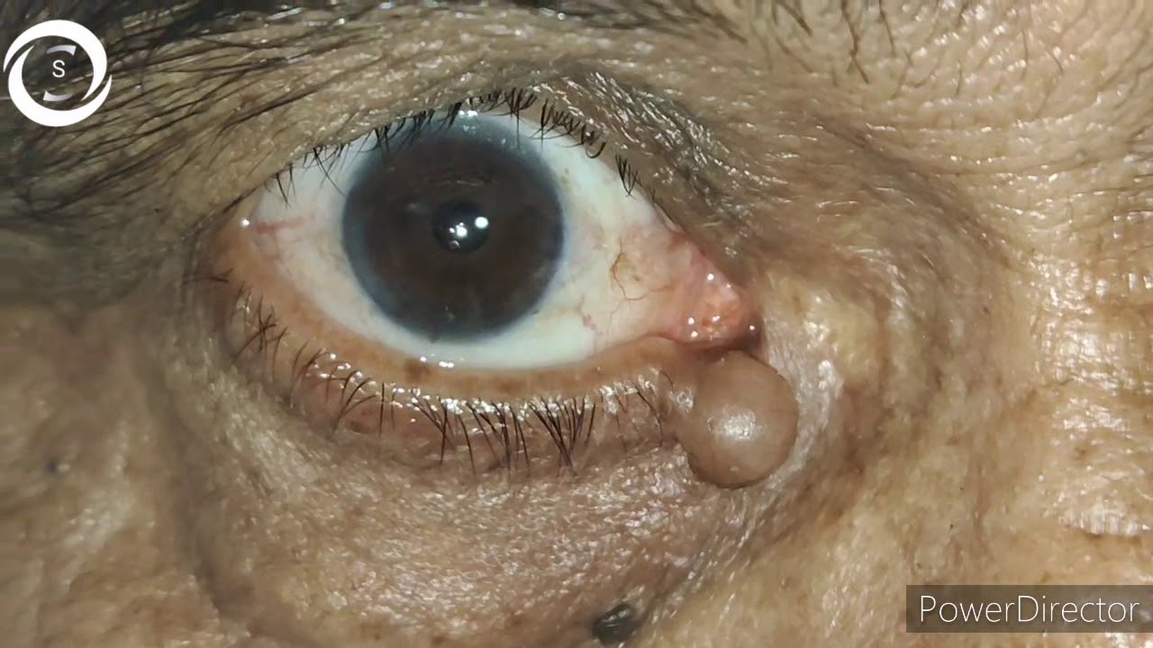Cyst Of Moll Youtube