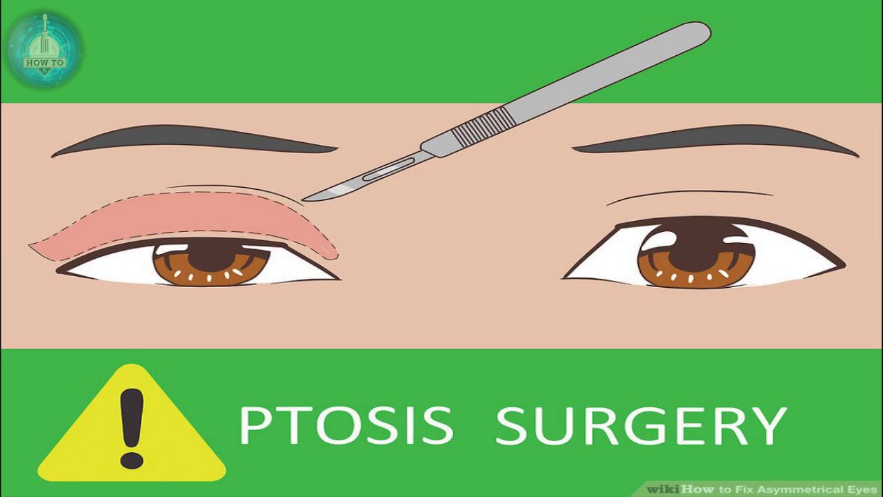 How to Fix Asymmetrical Eyes - YouTube