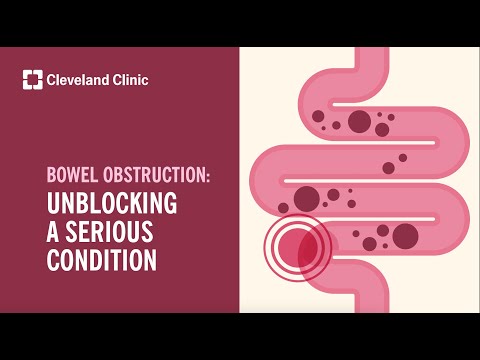 How Long Does It Take To Recover From Intestinal Blockage