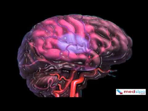 VDRL Test (Syphilis testing, symptoms, sample and normal results) - YouTube