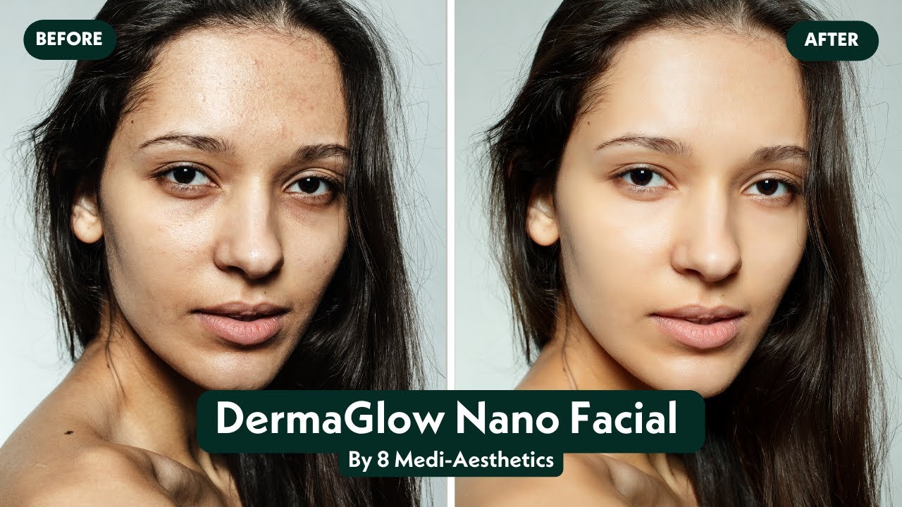 Ultimate Facial Treatment - Achieve Glowing Skin with DermaGlow Nano ...